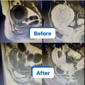 Pictures Of Fibroids | USA Fibroid Centers