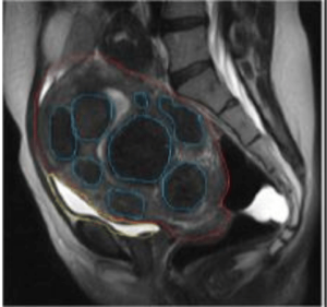 Pictures Of Fibroids | USA Fibroid Centers