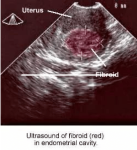 Pictures Of Fibroids | USA Fibroid Centers