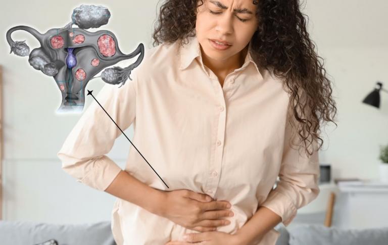 What Is Fibroid Sloughing? | USA Fibroid Centers