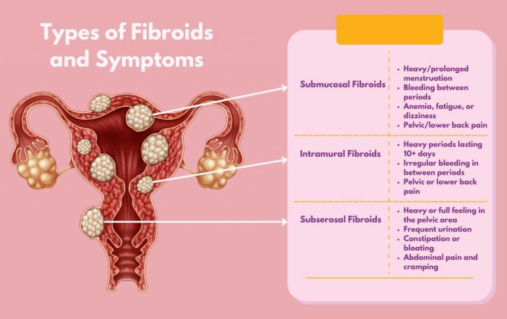 Why Do Fibroids Cause Heavy Bleeding And Clots During Period?