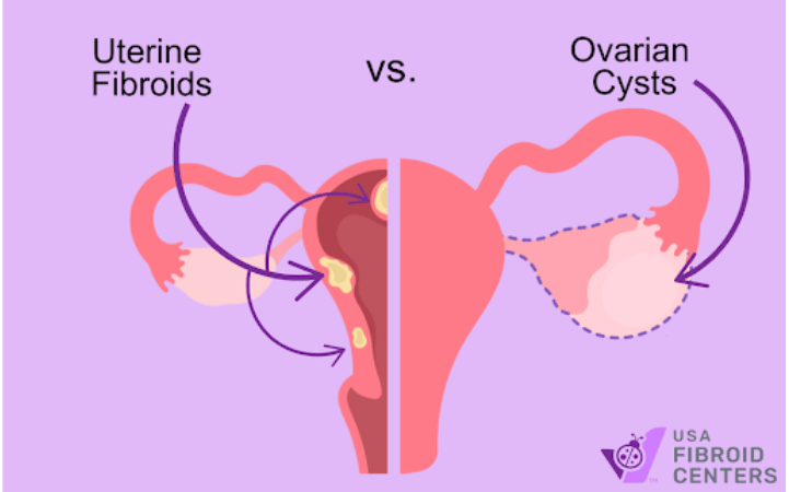 What's The Difference Between Cysts And Fibroids?
