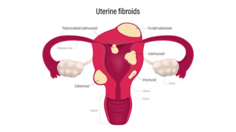Multiple Uterine Fibroids: Detection & Treatment