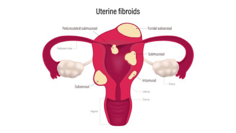 Multiple Uterine Fibroids: Detection & Treatment