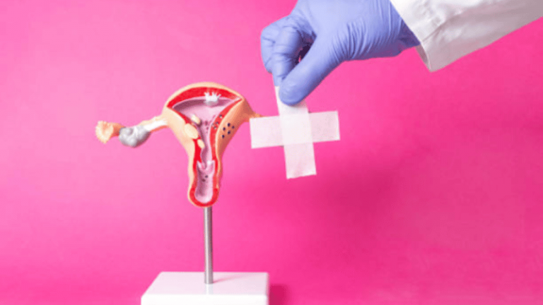 How To Shrink Fibroids: Fast & Effective Treatments