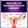 How To Check For Fibroids At Home