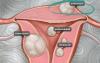 Do Subserosal Fibroids Need To Be Removed? | USA Fibroid Centers